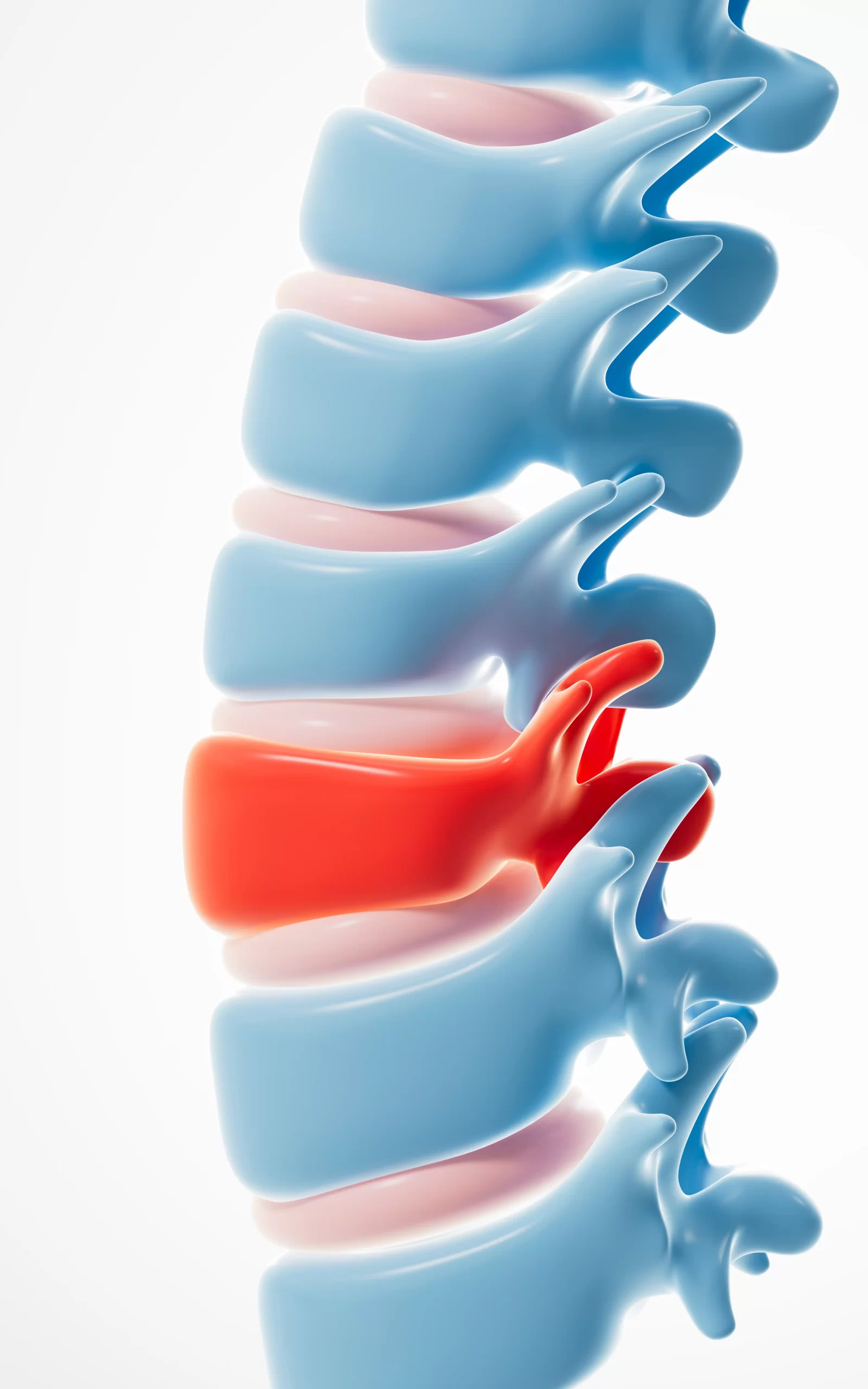 Extreme Lateral Interbody Fusion (XLIF) - Prof. Dr. Hazem Ahmed Elfezary